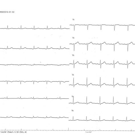Electrocardiogram Ecg Ecg Showed Qt Prolongation A Which Had Not