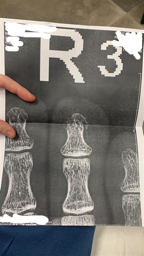 I Fractured My Toe Today Oc Rpics