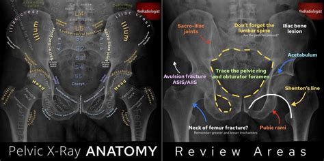 Pelvic X Ray Anatomy And Interpretation Checklist Anatomy Pelvis