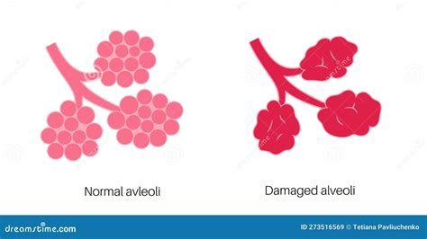 Emphysema Anatomical Poster Cartoon Vector 272993155