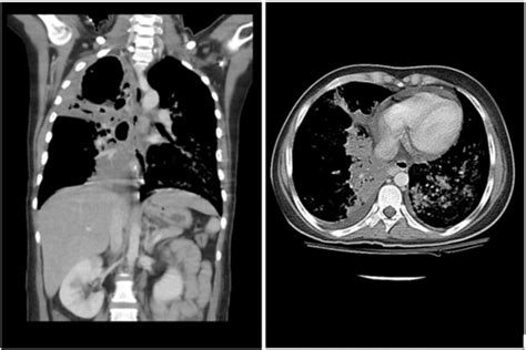 Ct Scan Of The Patient Showing Multiple Cavitation And Right Sided