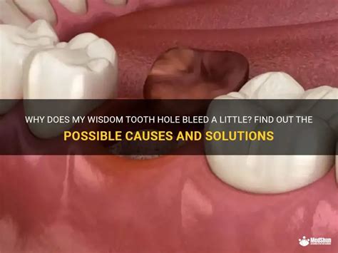 Why Does My Wisdom Tooth Hole Bleed A Little Find Out The Possible