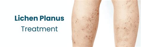 Best Treatment Options For Lichen Planus