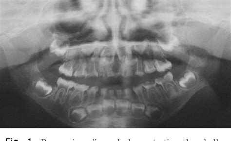 Figure 1 From Dentin Sialophosphoproteindspp Gene Mutation In A