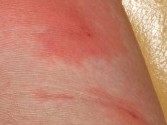 Bug Bites Cellulitis Infected Bug Bite Pictures Symptoms Treatment