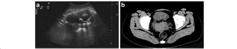 A Ultrasound Graph Revealed Echogenic Foci And Linear Reticular