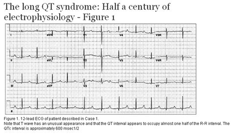 The Long Qt Syndrome Half A Century Of Electrophysiology British