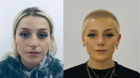 Facial Asymmetry How To Fix Asymmetrical Face Centre For Surgery