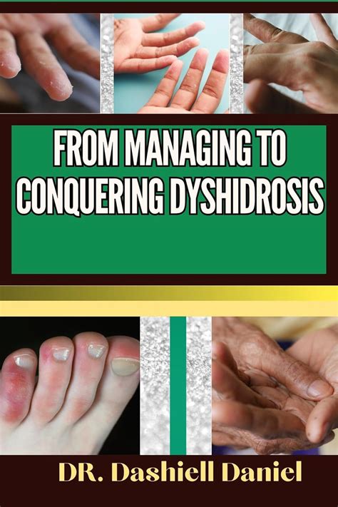 From Managing To Conquering Dyshidrosis Expert Guide To Understanding