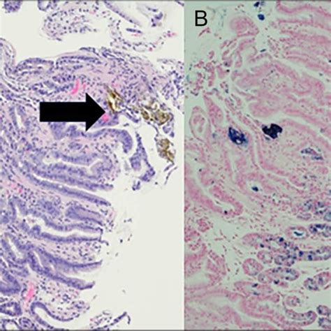 A Specimen From The Gastric Body Showed Reactive Gastropathy With
