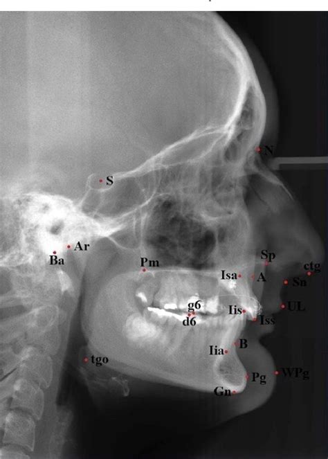 Figure 1 From Craniofacial Cephalometric Morphology In Caucasian Adult