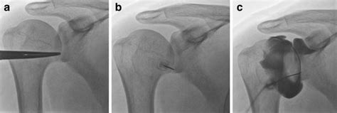 A Prospective Randomized Study Comparing Three Different Approaches To