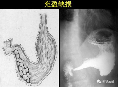 【x线诊断要点】胃肠道检查方法及正常x线表现(24个相关问题) 【x线诊断要点】胃肠道检查方法及正常x线表现(24个相关问题)