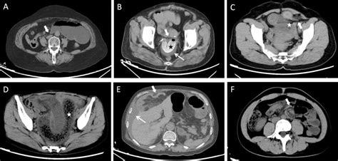 computed tomography features a beak sign thick arrow b closed loop