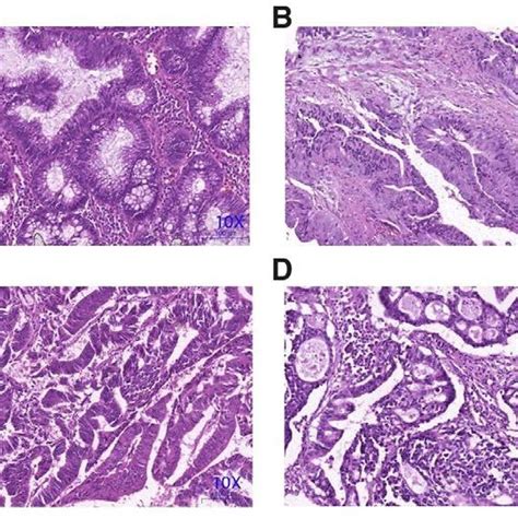 Colon Of Patients With Crc At Different Differentiation Stages By He Download Scientific