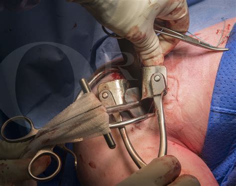 Open Modified Latarjet Coracoid Bone Block Transfer Anterior Shoulder