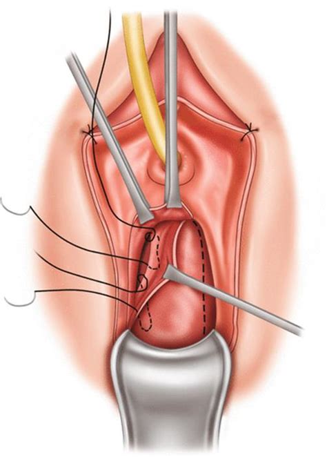 Surgical Repair Of Anterior Vaginal Wall Prolapse Atlas Of Vaginal Reconstructive Surgery 1st Ed