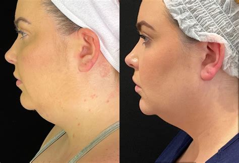 Coolsculpting Treatment The Cosmetic Skin Clinic