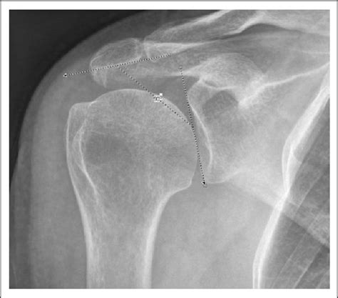 Laa The Laa Is The Angle Between The Glenoid And The Undersurface Of