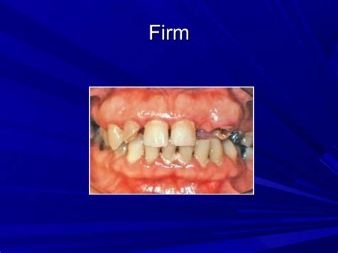 Gingivitis Ppt
