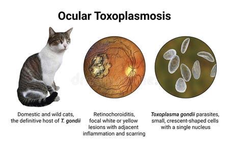 Ocular Toxoplasmosis Retinal Scar Caused By A Toxoplasma Gondii