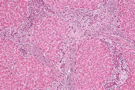 When Should The Size Of Fnh Focal Nodular Hyperplasia Raise Concerns
