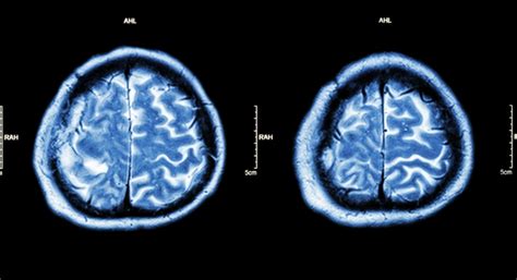 Gejala Stroke Pada Usia Mudah Faktor Risiko Dan Pencegahnya Kortex