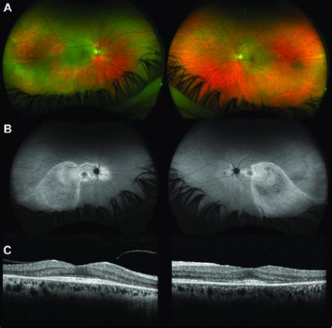 Case 6 A Fundus Photography Showing Subtle Discrete Areas Of RPE Download Scientific