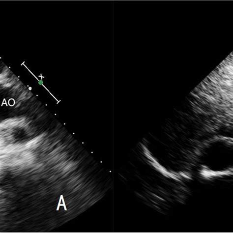A Left Ventricular Long Axis View Shows A Large Mass In The Download Scientific Diagram