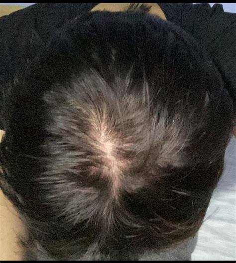 Am I Balding I Turned 18 A Month And A Few Days Ago My Dad And His 2 Brothers Are All Balding