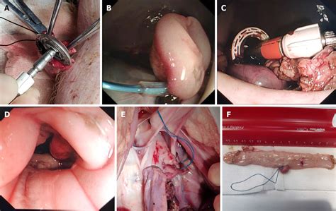 Peroral Traction Assisted Natural Orifice Trans Anal Flexible
