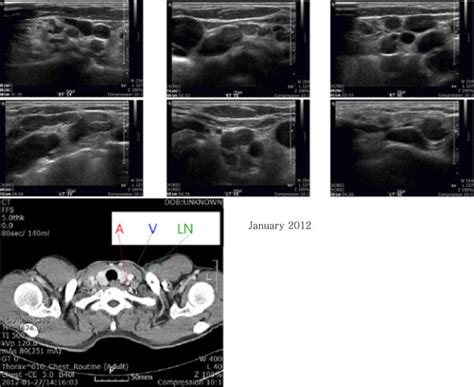 Thyroid And Neck Sonography Enlargement Of Multiple Lymph Nodes Download Scientific Diagram