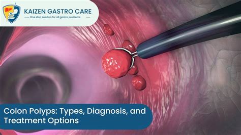Colon Polyps Types And Treatment Kaizen Gastro Care