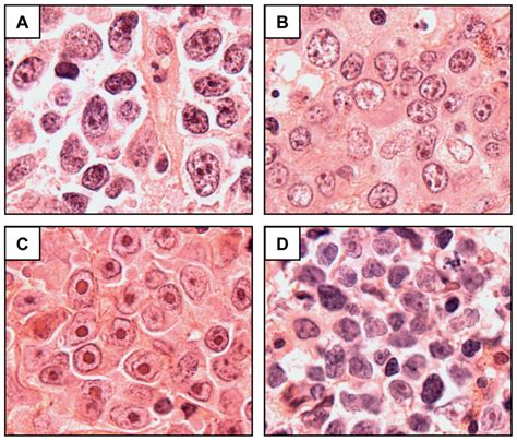 Morphological Features Of Select Myc Ihc High Dlbcls Hematoxylin And