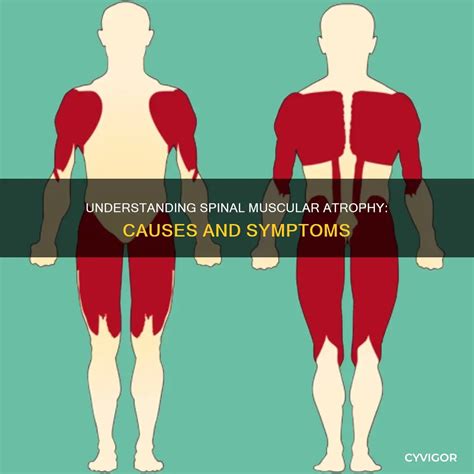 Understanding Spinal Muscular Atrophy Causes And Symptoms Cyvigor