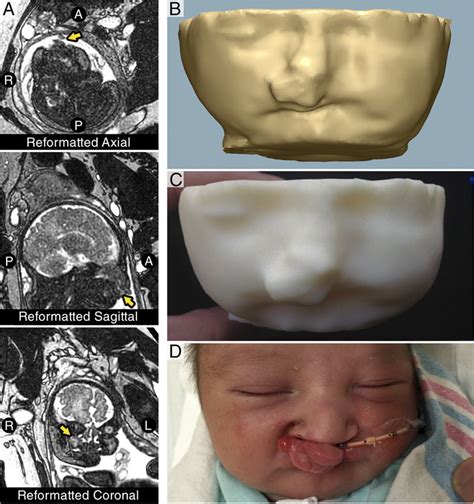 Segmentation Modeling And 3d Printing Of Fetal Mri A Download