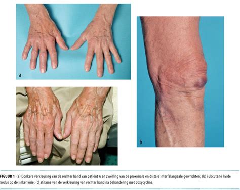 Acrodermatitis Chronica Atrophicans