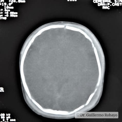 Hematoma Subgaleal Frontoprietal Izq Y Occipital Caput 1996 Dr