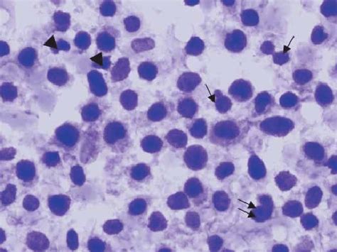 Bone Marrow Numerous Apoptotic Cells With Pyknotic Nuclei And Budding
