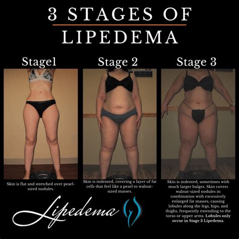 Interstitial Fluid What Is It And How Does It Impact Lipedema And