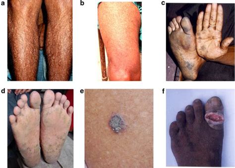 Arsenic Poisoning Medchrome