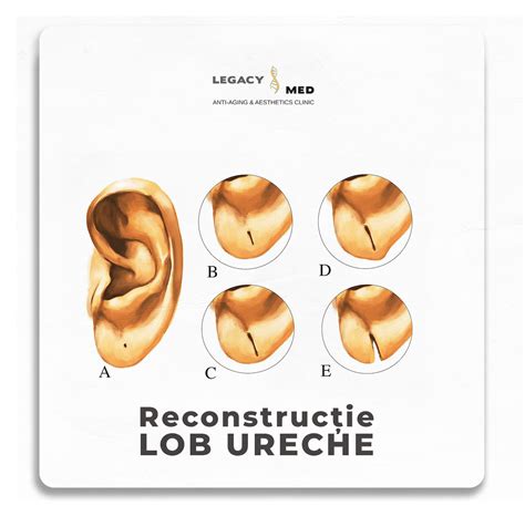 Reconstructie Lob Ureche Legacy Med
