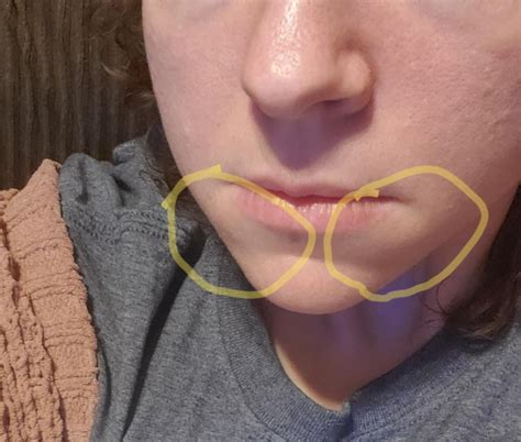 Chipmunk Cheeks Is This What It Looks Like Eating Disorder Support Forum