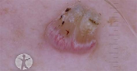 Verruca Vulgaris Dermoscopy Image