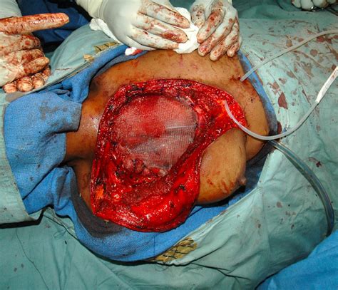 Earthwide Surgical Foundation Chest Wall Sarcoma