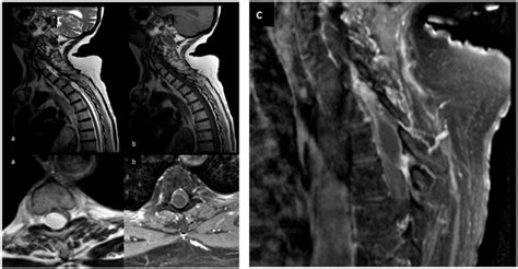 Mri Thoracic Spine A T2 Saggital And Axial B T1 Pre Contrast
