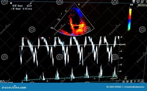 Echocardiogram Or Echo Exam For Heart Disease Diagnosis Outline Diagram