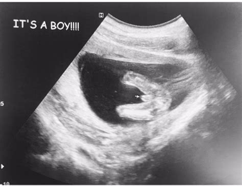 Its A Boy Ultrasound 14 Weeks