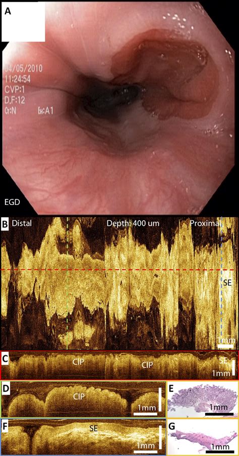Three Dimensional Endoscopic Optical Coherence Tomography Imaging Of