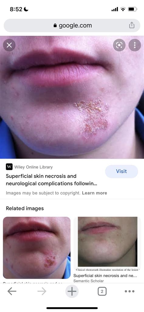 Could It Be Necrosis Its Very Serious If It Is It Means The Nerves